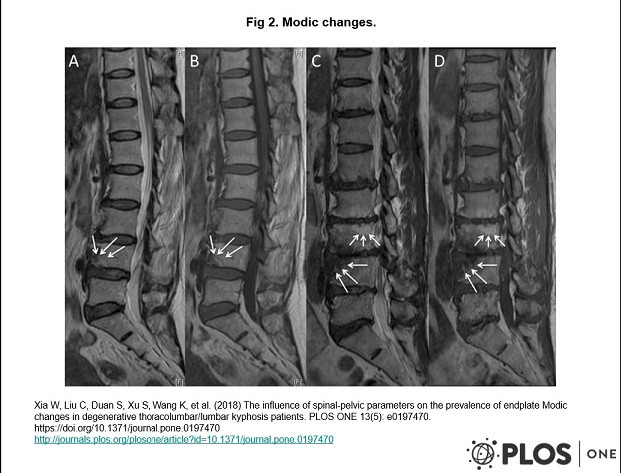 Modic zmeny a ich vplyv na bolesti chrbtice :: Masážna terapia - Roland ...